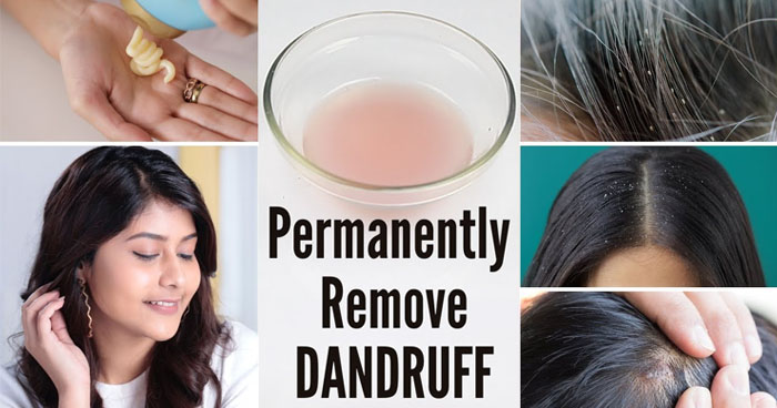 How To Get Beautiful Dandruff Free Hair In Just 4 Weeks